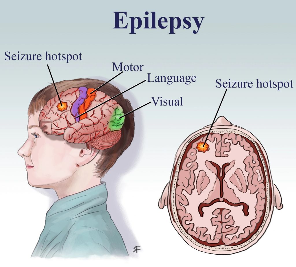 Epilepsy - Best Epilepsy Specialist in Nagpur - Dr. Ritesh Nawkhare